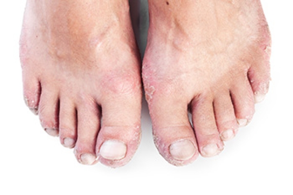 Psoriatic arthritis feet store